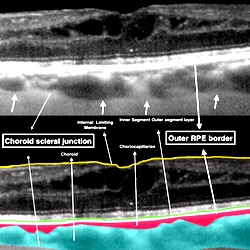 Enhanced depth imaging (EDI) scan from spectral domain optical ...