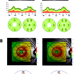 Representative Spectralis SD-OCT scans of (A) retinal nerve fiber layer ...