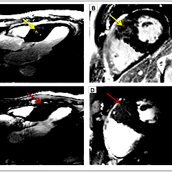 Case example: Patient with myocardial crypts.