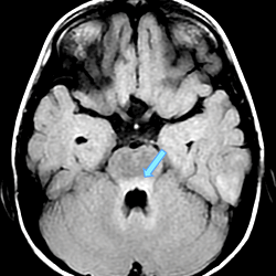 T2/FLAIR hyperintensities noted in posterior 1/3 of pons ...