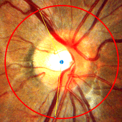 An example of the peripapillary retinal arteries angle measurement ...