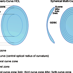 Rigid gas-permeable hard contact lens (HCL) design.