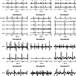 Examples of aECG signals from the ADFECGDB database.