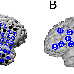 ECoG grid and sEEG shanks locations.