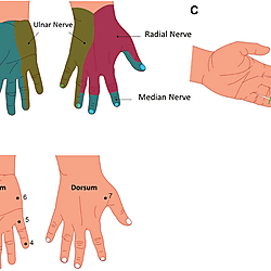 Dermatomes of the radial, ulnar and median nerves and the 7-SWM-test ...