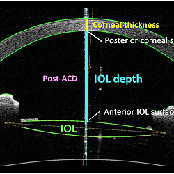 IOL depth measured using anterior-segment optical coherence tomography.