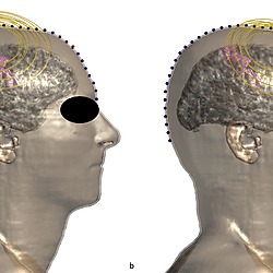 Coil placement process.