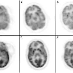 Reconstructed axial comparisons of uncorrected data, frame-based ...