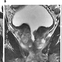 TURP defect affects measurements.