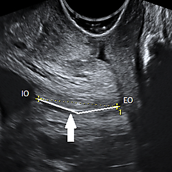 CL measurement curve line technique.