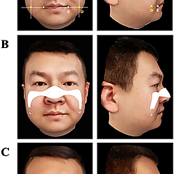 3D face scans acquired with face scanning APP and CAD of retainer.