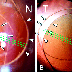Schematic of relationship between anterior capsule (white arrow) and ...