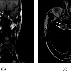 Representative appearance of cavernoussinus invasion (CSI) on multi ...