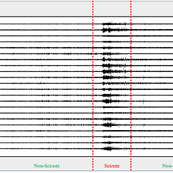 Epileptic EEG signals.
