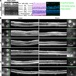 Retinopathy progression of acute RVO in OCT.