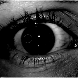 Iris-shade grading technique.