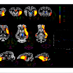 NAc DBS elicits distal network BOLD changes.
