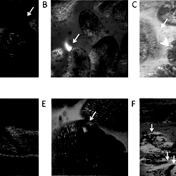 Endomicroscopic and Transcriptomic Analysis of Impaired Barrier ...