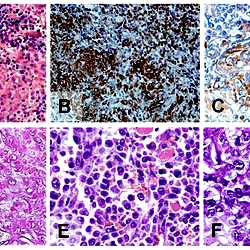 Microscopic morphology of GW-584 human mediastinal lymphoma and ...