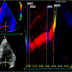 Cardiac time intervals assessed by a color tissue Doppler imaging (TDI ...