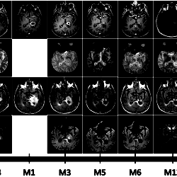 Evolution of a left thalamic abscess (patient #10) from day 1 to month 30.