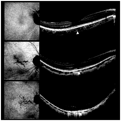 Examples of indocyanine green angiography (ICGA) and spectral domain ...