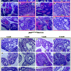 Development of PIN lesion in PtenloxP/loxP:Osr1-Cre mice.