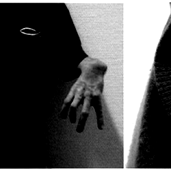 Upper-extremity dysmelia.