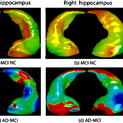 Hippocampal shape differences among normal controls (NC), mild ...