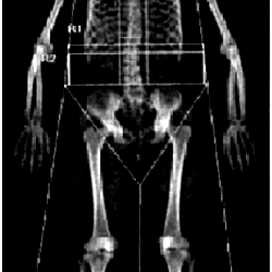 L1L4 and L2L4 regions on whole body DXA scan.