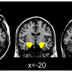 The medial temporal lobe (MTL) ROI.