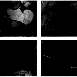 Figure A shows the T2prep image of the RCA in a patient with CAD, while ...