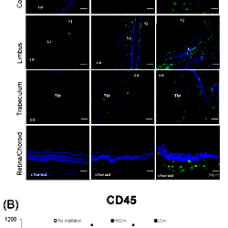 CD45-positive cell infiltration.
