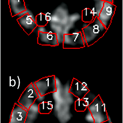 ROI selection for ROI-based comparison between PET-CBF and ASL-CBF maps.