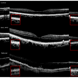 Qualitative High Density (HD) Raster Scan Assessment of Choriocapillaris.