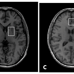 MRS voxel locations.