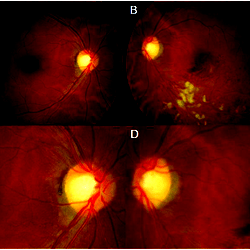 A case of rim pallor type (Group 3).