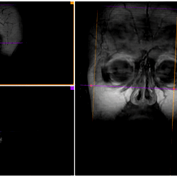 Plotted landmarks on 3D rendered images with MPR view.