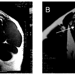 Sagittal oblique TIWI images of subcoracoid fat triangle in control ...