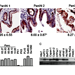 LCN2 expression in pancreatic neoplastic lesions and PDAC cell lines.