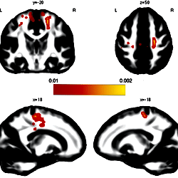 TBSS Whole-brain comparison between ALS patients and HC.