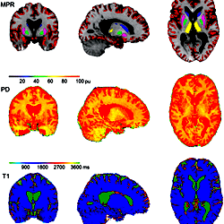 Representative example for calculated quantitative maps and ...