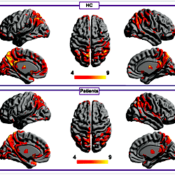 Within-group ALFF maps for the healthy control and cirrhotic patient ...