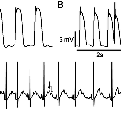 CPVT patients show afterdepolarizations and corresponding ECG changes. A