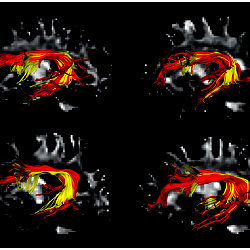 Segmentation of the superior longitudinal fasciculus (SLF) with DTI and ...