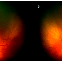 Retinal images of an infant with APROP (case no:29).