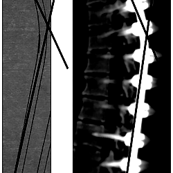 Rod angle before and after implantation.