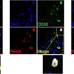 Cellular localization of hepatic RANK in PBC.