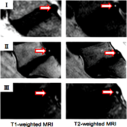 High Intensity Zones based on signal types on T1- and T2- weighted MRI.