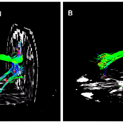 Example of DTI fiber tractography on one healthy control and one MHE ...